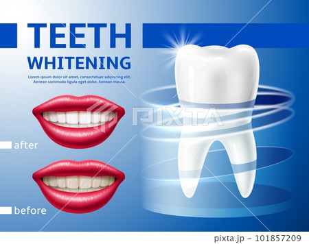 Teeth whitening poster. Realistic 3d smiling...のイラスト素材 [101857209] - PIXTA