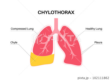 Chylothorax anatomical posterのイラスト素材 [102111862] - PIXTA