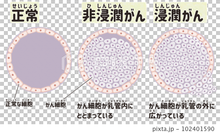 Breast cancer Illustrated illustrations of... - Stock Illustration ...