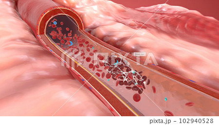 A blood clot is red blood cells that stick...のイラスト素材 [102940528] - PIXTA
