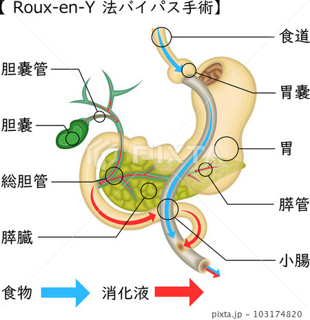 Roux-en-Y法バイパス手術 イラスト 日本語のイラスト素材 [103174820] - PIXTA