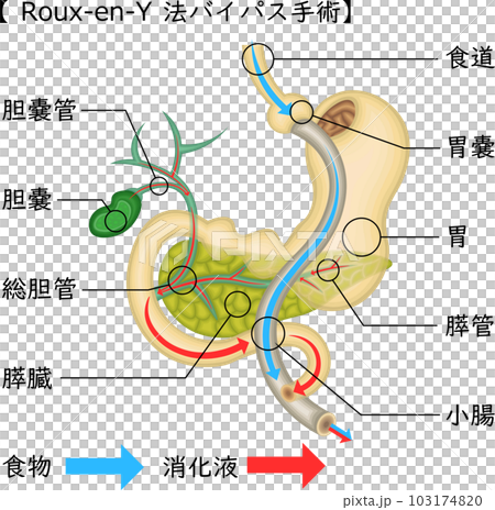 Roux-en-Y法バイパス手術 イラスト 日本語のイラスト素材 [103174820] - PIXTA