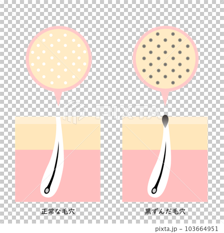 Comparison of normal skin and darkened skin.... - Stock Illustration ...