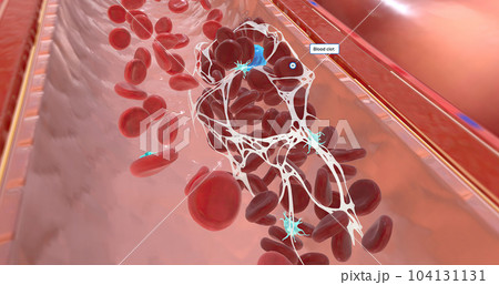 A blood clot is red blood cells that stick...のイラスト素材 [104131131] - PIXTA