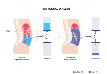 Peritoneal Dialysis Diagram Patient Education And Care For Peritoneal