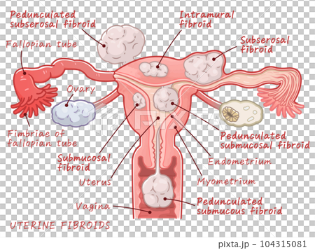 Uterine fibroids,ovary, uterus, illustration,... - Stock Illustration ...