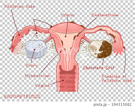 ENDOMETRIOSIS, Chocolate Cyst, ovary, uterus,... - Stock Illustration ...
