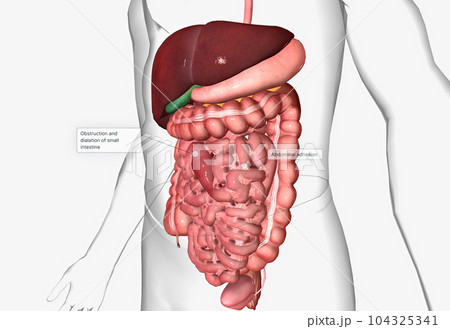 Abdominal adhesions, also called small...のイラスト素材 [104325341] - PIXTA