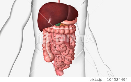 Abdominal adhesions are bands fibrous tissue...のイラスト素材 [104524494] - PIXTA