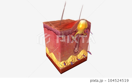 Pustules are a type of acne characterized by...のイラスト素材 [104524519] - PIXTA