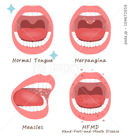 tongue,koplik spots,measles,Herpangina,HFMDのイラスト素材 [104672659] - PIXTA