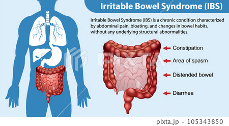 Irritable Bowel Syndrome (IBS) Infographicのイラスト素材 [105343850] - PIXTA