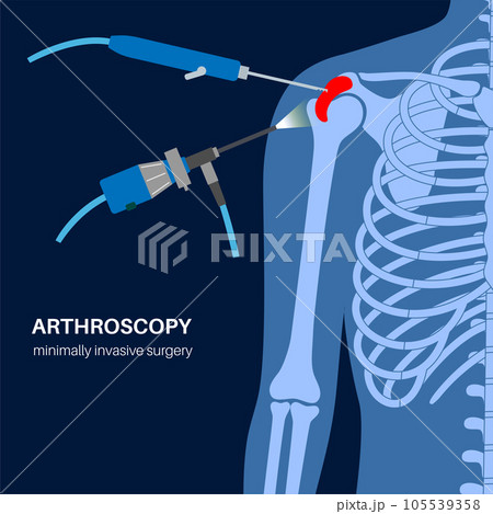 Shoulder arthroscopy posterのイラスト素材 [105539358] - PIXTA