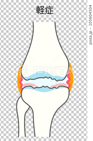 Illustration of mild knee osteoarthritis - Stock Illustration ...