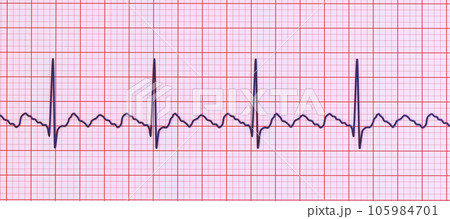 ECG in atrial flutter, 3D illustrationのイラスト素材 [105984701] - PIXTA