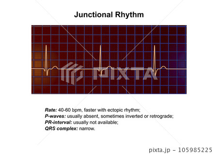 Junctional Rhythm Ecg