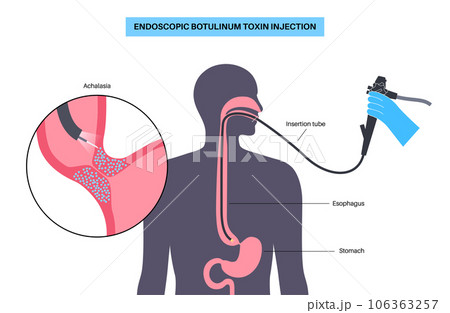 esophageal botulinum toxin injectionのイラスト素材 [106363257] - PIXTA