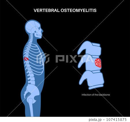 Vertebral osteomyelitis posterのイラスト素材 [107415875] - PIXTA