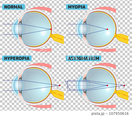 Myopia, hyperopia, presbyopia, astigmatism,... - Stock Illustration ...