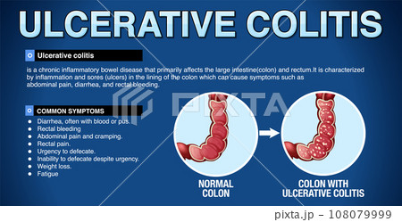Ulcerative Colitis Symptoms Infographicのイラスト素材 [108079999] - PIXTA