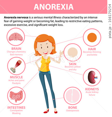 Unhealthy Female Anatomy: Anorexia's Effects on...のイラスト素材 [108170254 ...