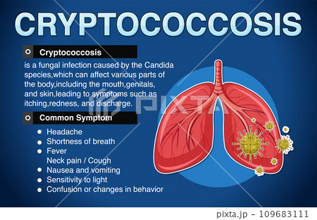 Informative poster of Cryptococcosisのイラスト素材 [109683111] - PIXTA
