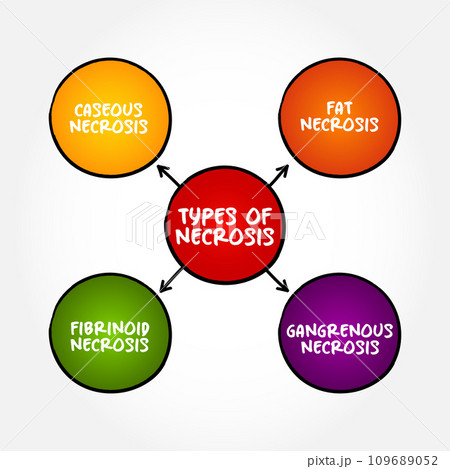 Types of Necrosis (death of body tissue) mind...のイラスト素材 [109689052] - PIXTA