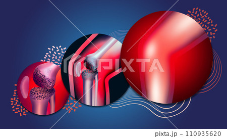 Arthrosis medical illustration diagram with...のイラスト素材 [110935620] - PIXTA