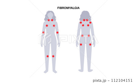 Fibromyalgia medical posterのイラスト素材 [112104151] - PIXTA