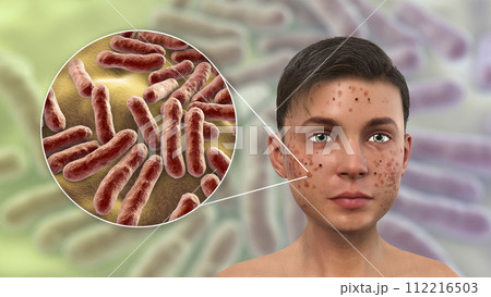 Acne vulgaris and bacteria Cutibacterium acnesのイラスト素材 [112216503] - PIXTA