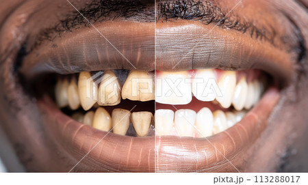 Split image of a man's teeth before and after...のイラスト素材 [113288017] - PIXTA