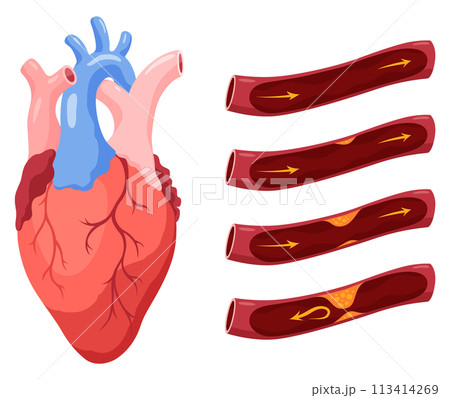 Atherosclerosis stages. Anatomy of heart...のイラスト素材 [113414269] - PIXTA