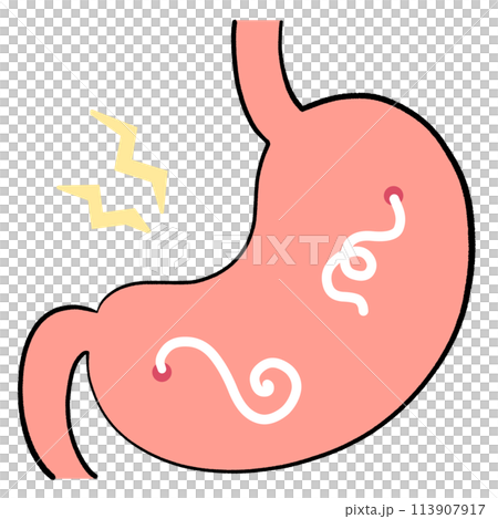 Illustration of gastric anisakiasis - Stock Illustration [113907917 ...