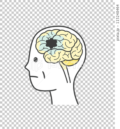 Illustration of parts of the brain damaged by... - Stock Illustration ...