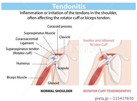 Understanding Shoulder Tendonitisのイラスト素材 [115417630] - PIXTA