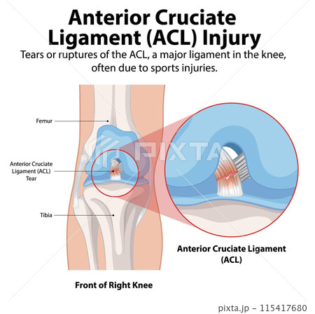 ACL Injury and Knee Anatomyのイラスト素材 [115417680] - PIXTA