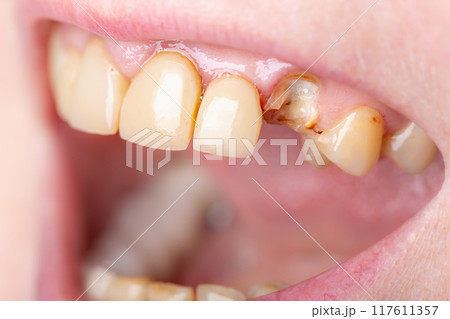 Bad damage tooth, lost teethの写真素材 [117611357] - PIXTA
