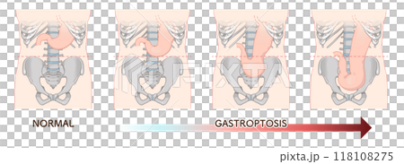 Gastroptosis, stomach, gastric atony, STAGE OF... - Stock Illustration ...