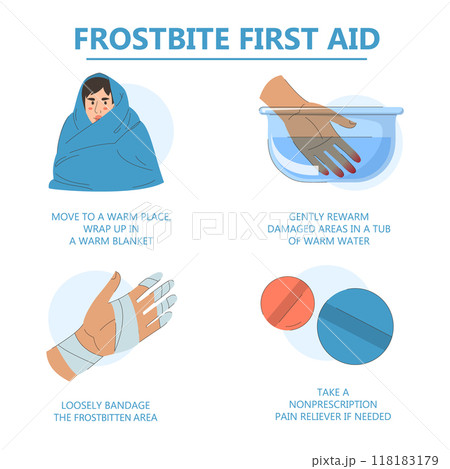 Frostbite infographic. First aid instructionsのイラスト素材 [118183179] - PIXTA