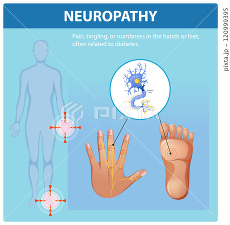 Understanding Neuropathy and Its Symptomsのイラスト素材 [120999395] - PIXTA