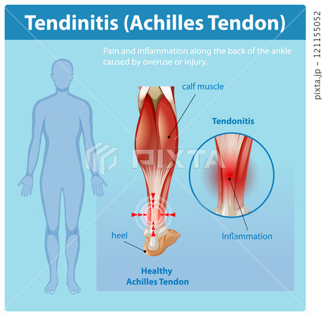 Achilles Tendonitis Medical Illustrationのイラスト素材 [121155052] - PIXTA