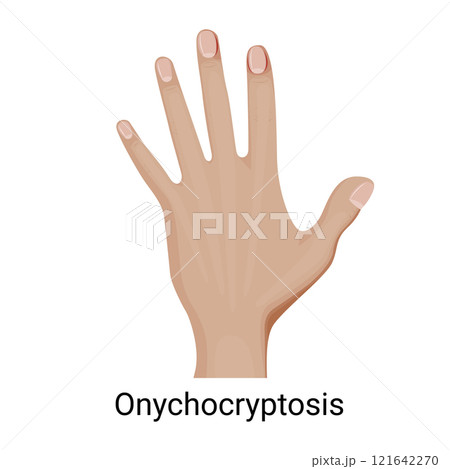 Onychocryptosis on the hand vector illustration.のイラスト素材 [121642270] - PIXTA