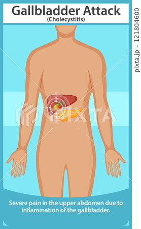 Understanding Gallbladder Attack Symptomsのイラスト素材 [121804600] - PIXTA