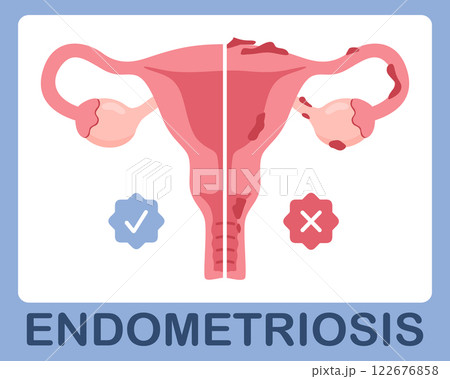 Uterus with endometriosis infographic in flat...のイラスト素材 [122676858] - PIXTA