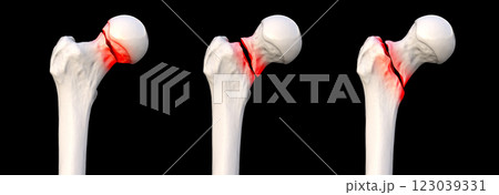 Femur neck fracture types: subcapital,...のイラスト素材 [123039331] - PIXTA