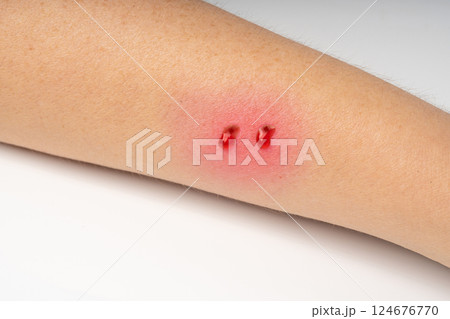 What Does A Snake Bite Wound Look Like
