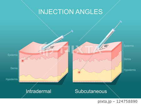 Injection technique. Needle angleのイラスト素材 [124758890] - PIXTA