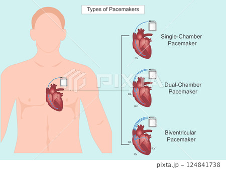 The different types of pacemakers.のイラスト素材 [124841738] - PIXTA