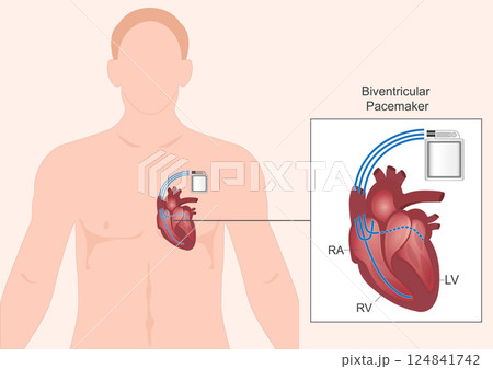 Biventricular pacemakers.Type of pacemaker.のイラスト素材 [124841742] - PIXTA
