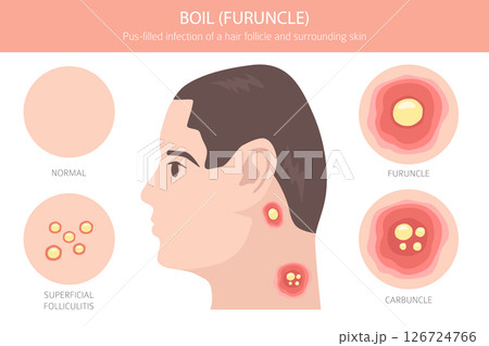 Boil, Furuncle, carbuncle. Skin diseases....のイラスト素材 [126724766] - PIXTA